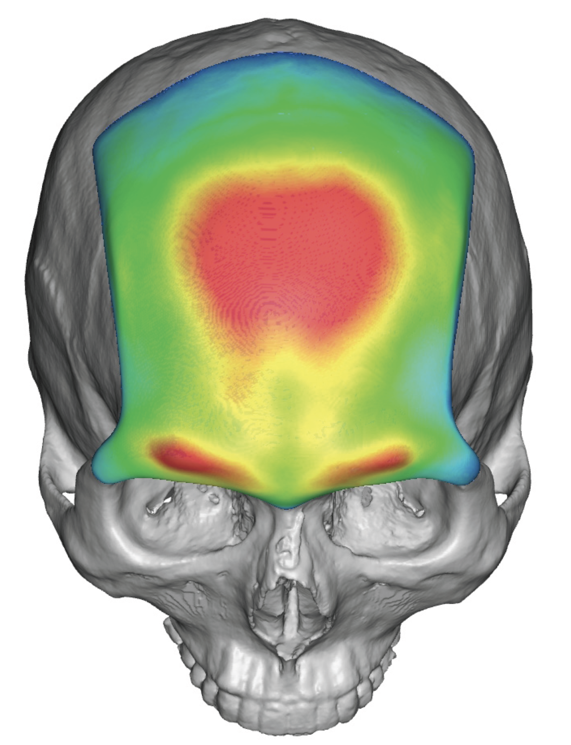 Plastic Surgery Case Study - Male Custom Forehead Brow Bone Implant for ...
