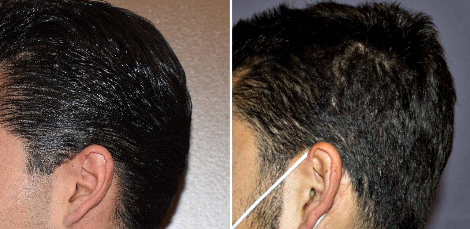 Plastic Surgery Case Study - Secondary Custom Skull Implant Replacement ...