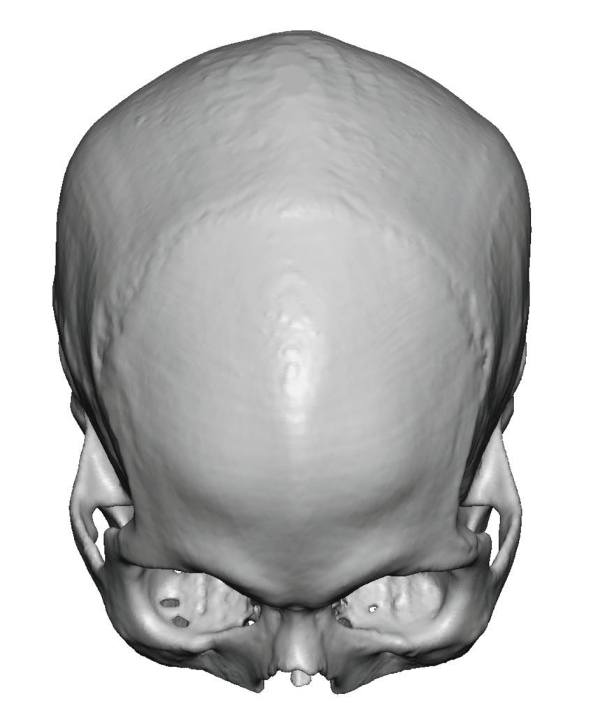 Plastic Surgery Case Study - Custom Forehead-Temporal Head Widening ...