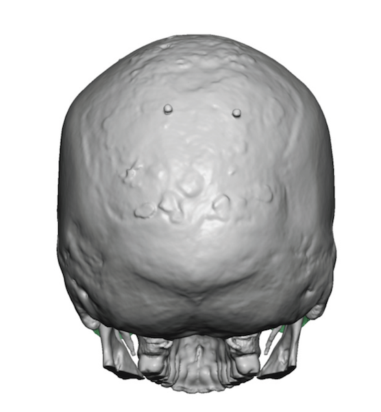 PMMA crown of head skull augmentation back view 3D CT scan Dr Barry ...