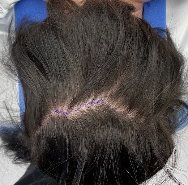 Technical Strategies - First Stage Scalp Expansion for Large Custom ...