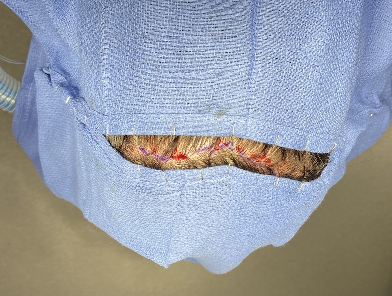 back of head scalp incisional draping for scalp tissue expander ...