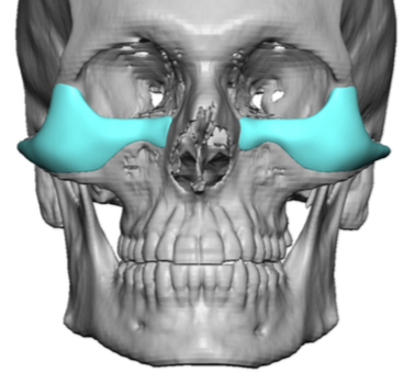 custom infraorbital malar implants design front view Dr Barry Eppley ...