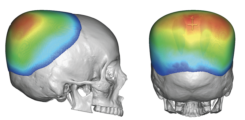 Plastic Surgery Case Study - Large Two-Stage Skull Implant Augmentation ...