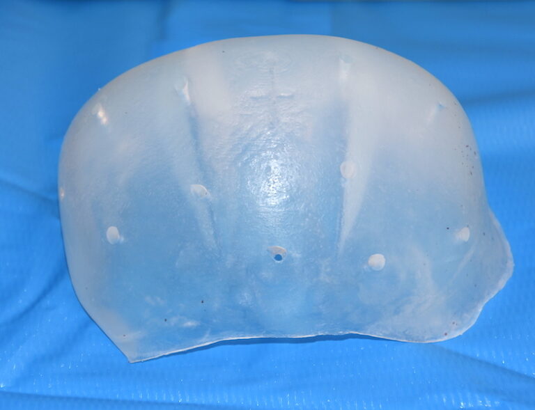 female large custom skull implant intraop DR Barry Eppley Indianapolis ...