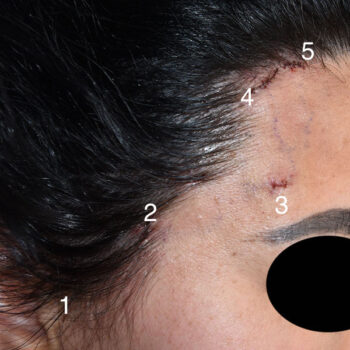 temporal artery ligation Archives - Page 2 of 4 - Explore Plastic Surgery