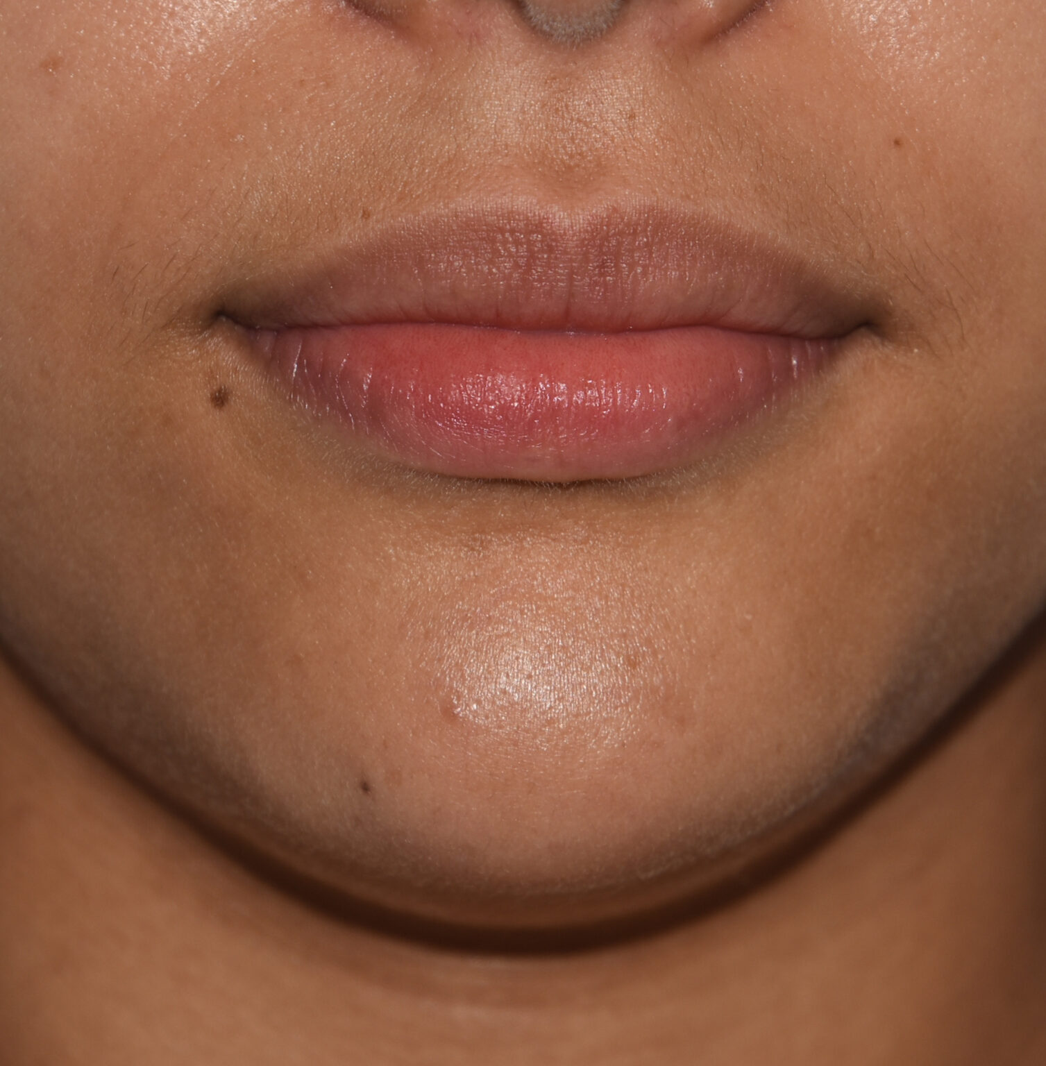 Plastic Surgery Case Study - Submental Tuck Approach To The Treatment ...