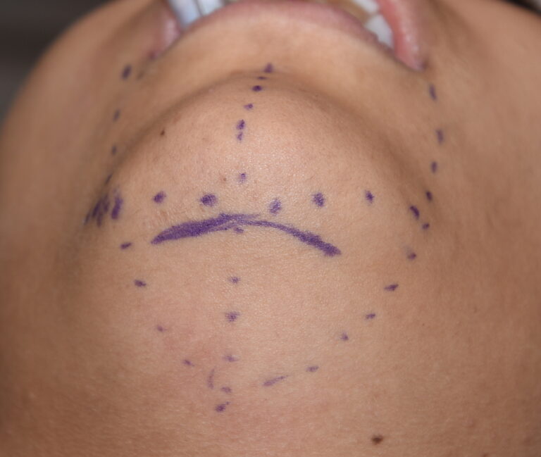 Plastic Surgery Case Study - Submental Tuck Approach To The Treatment ...