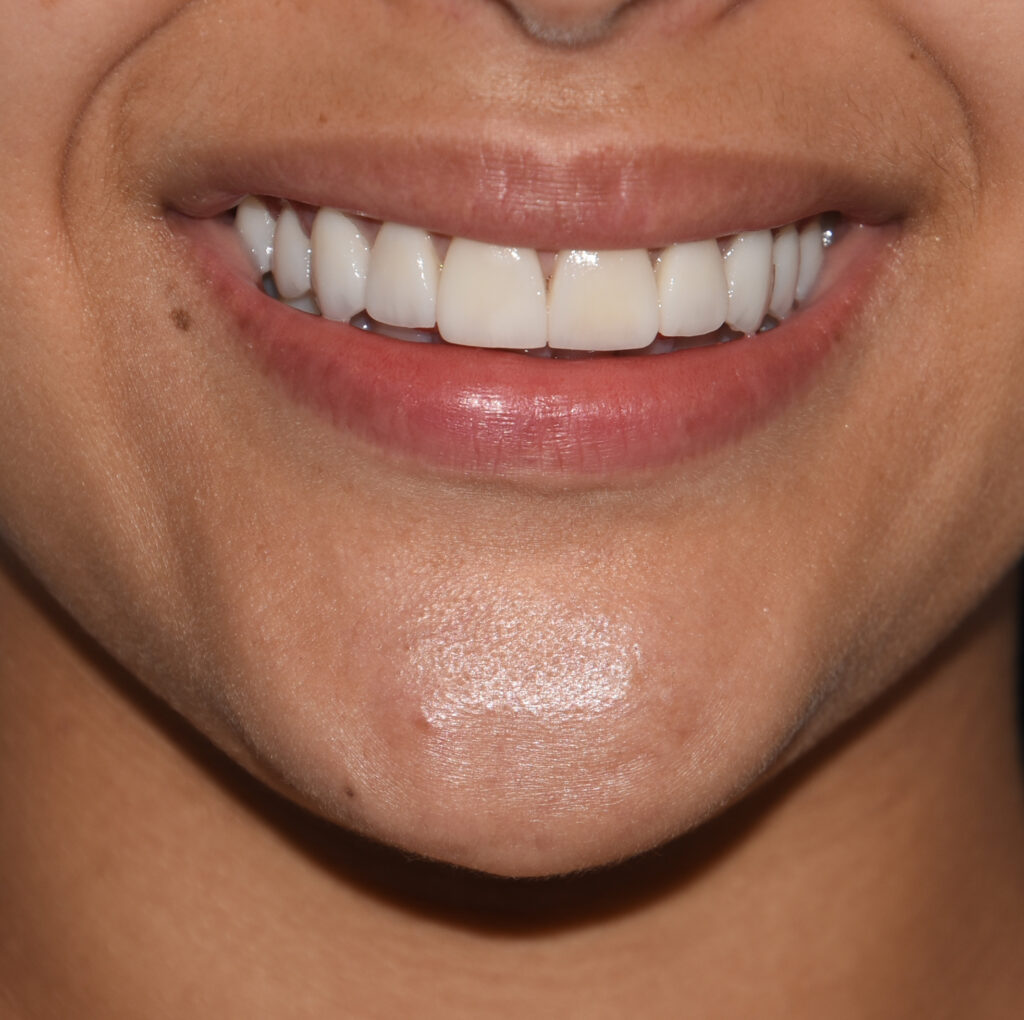 Plastic Surgery Case Study - Submental Tuck Approach To The Treatment ...