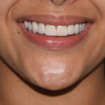 hyperdynamic chin ptosis when smiling front view Dr Barry Eppley ...