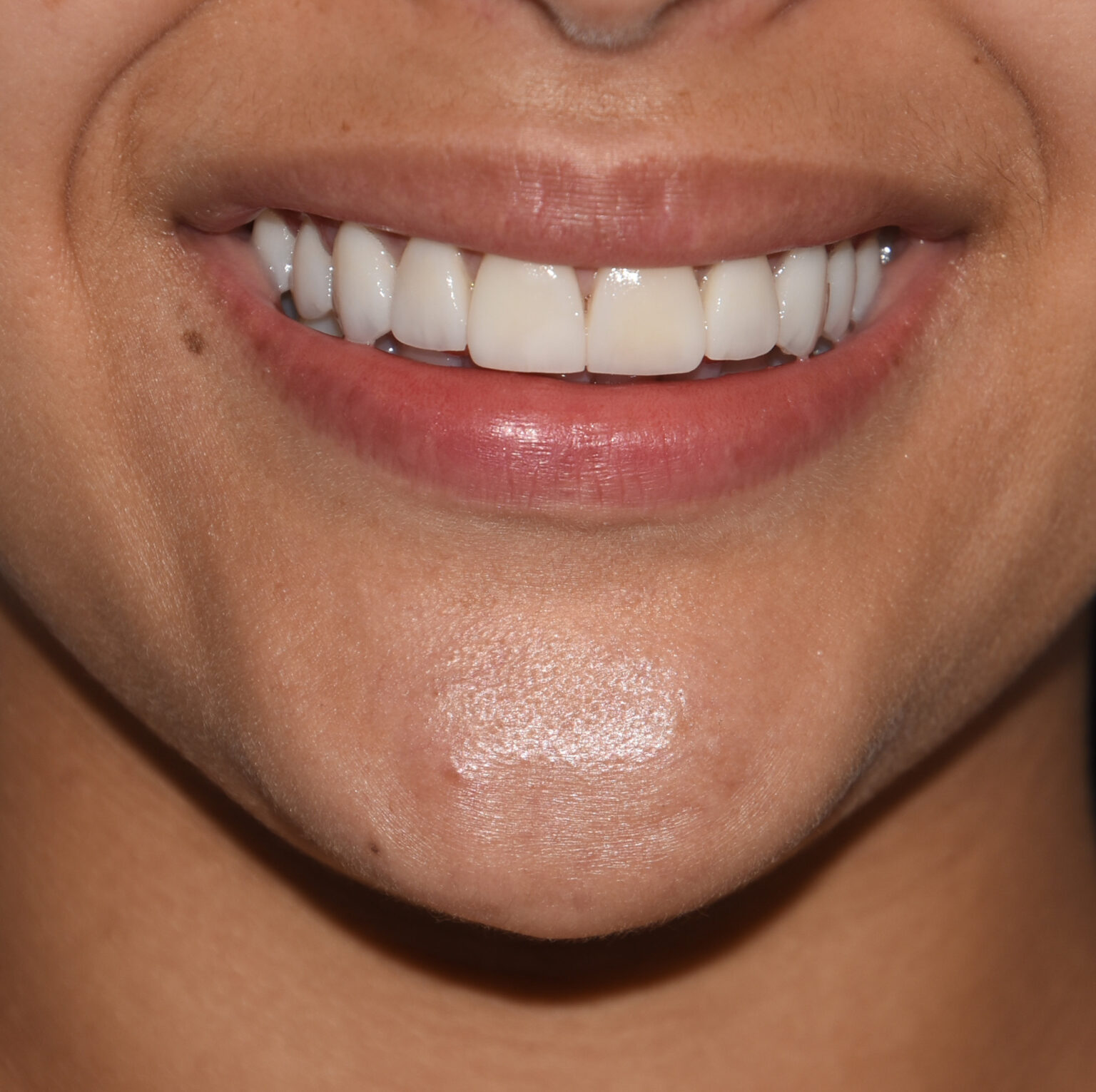 hyperdynamic chin ptosis when smiling front view Dr Barry Eppley ...