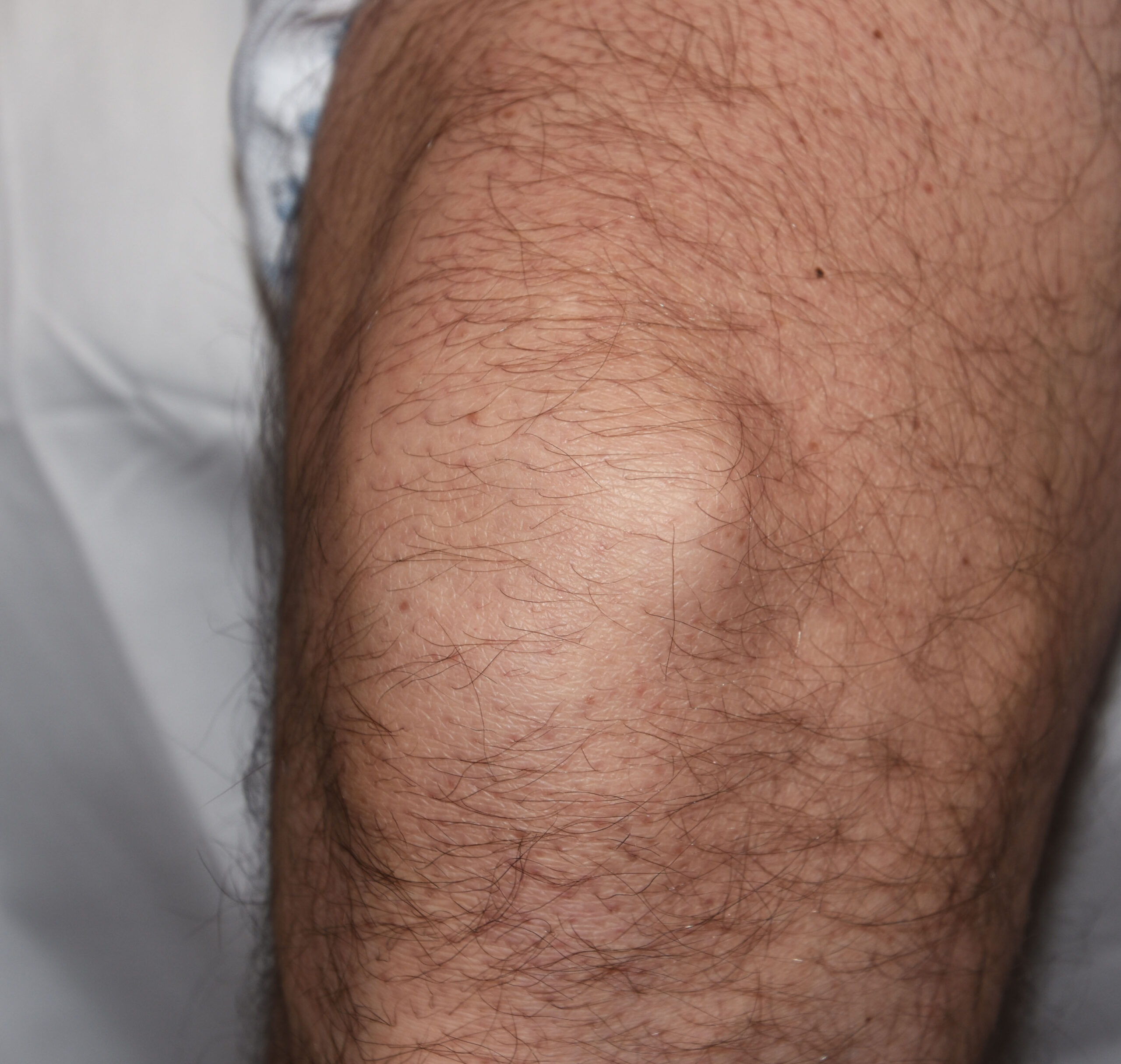 male patellar shave before Dr Barry Eppley Indianapolis - Explore ...