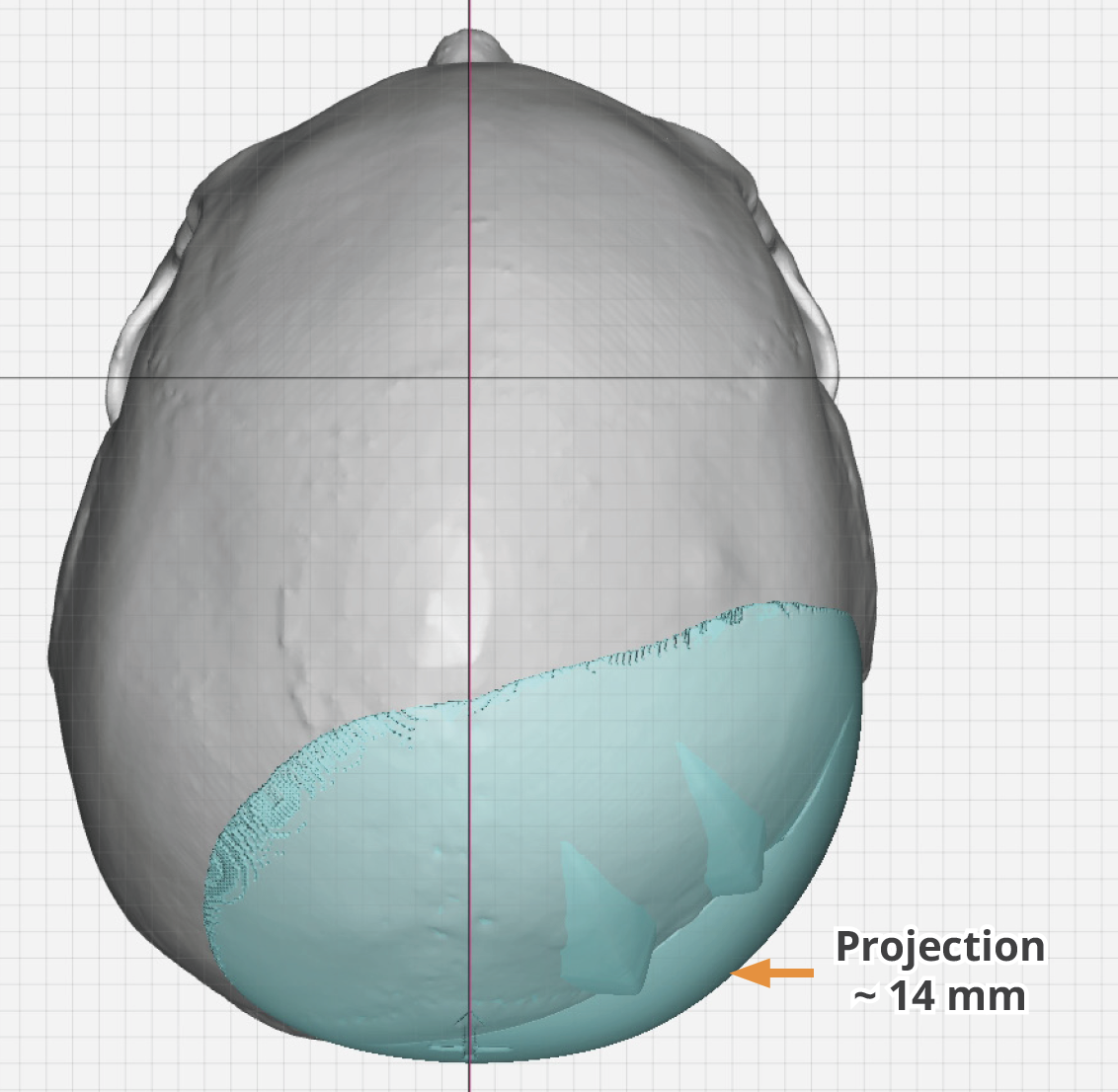 male right flat bacl of head custom skull implant thickness - Explore ...