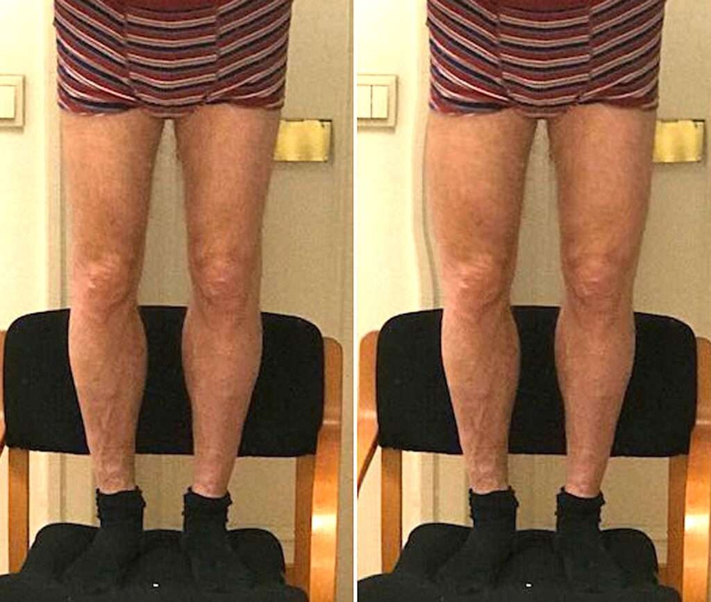Plastic Surgery Case Study - Thigh Implants for Calf Implant-Induced ...