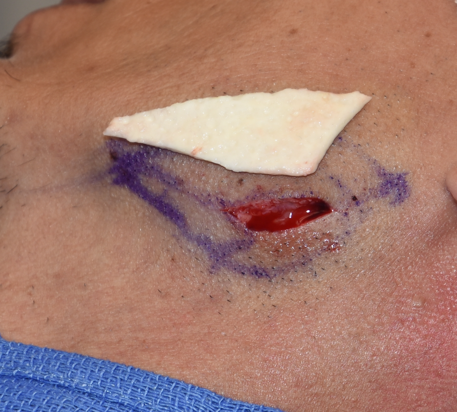 Technical Strategies - Direct Jaw Angle Implant Incision for Masseteric ...