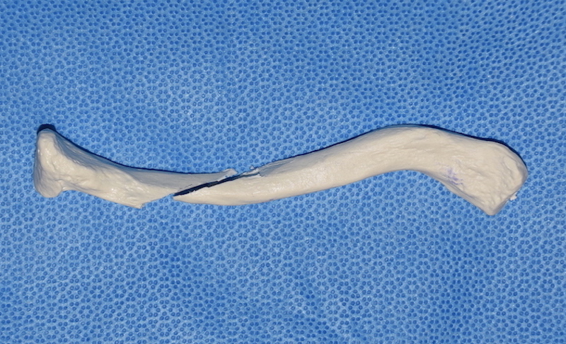 Clavicle Lengthening Osteotomy Patterns for Shoulder Widening Surgery ...