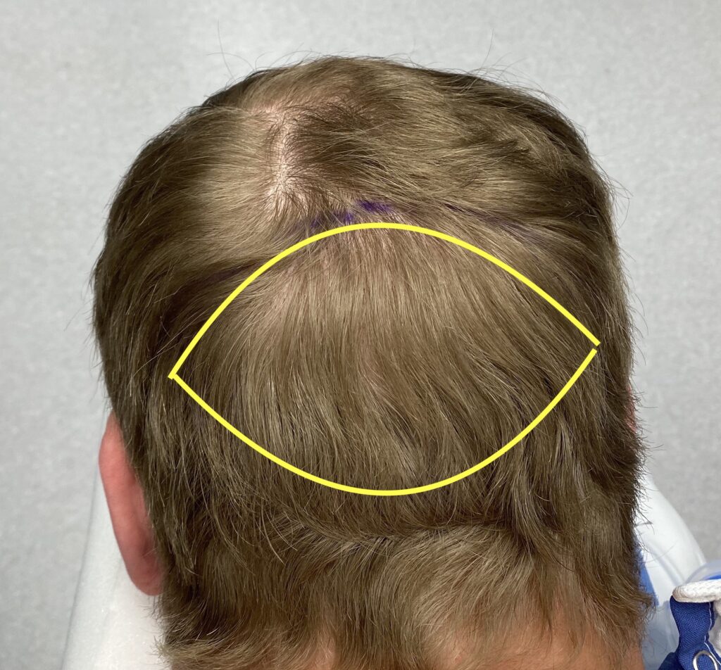 Plastic Surgery Case Study - Reduction of The Occipital Skull Bony ...