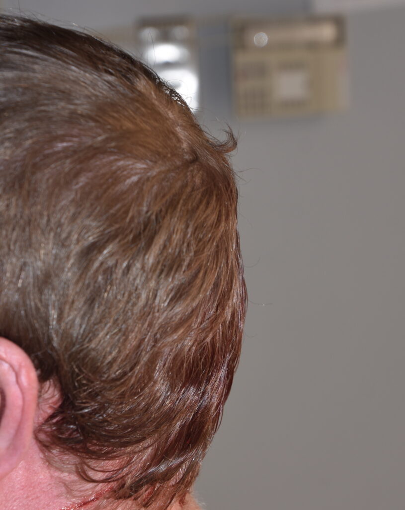 Plastic Surgery Case Study - Reduction of The Occipital Skull Bony ...