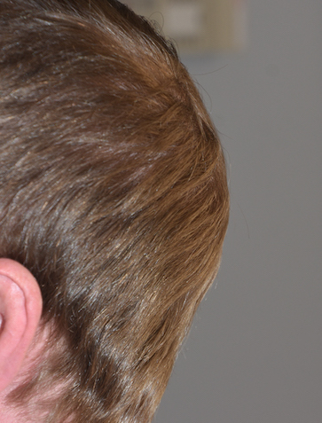 Plastic Surgery Case Study - Reduction of The Occipital Skull Bony ...