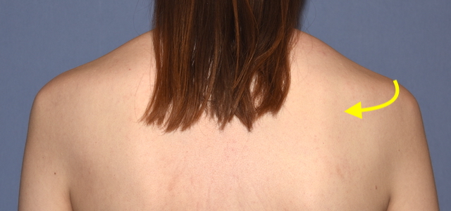 Technical Strategies - Double Plate Fixation of Clavicle Reduction ...