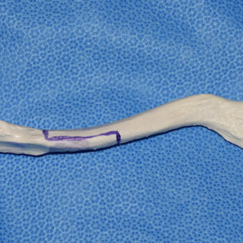 shoulder widening Archives - Explore Plastic Surgery