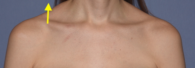 Technical Strategies - Double Plate Fixation of Clavicle Reduction ...