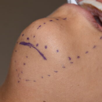 chin reduction Archives - Explore Plastic Surgery