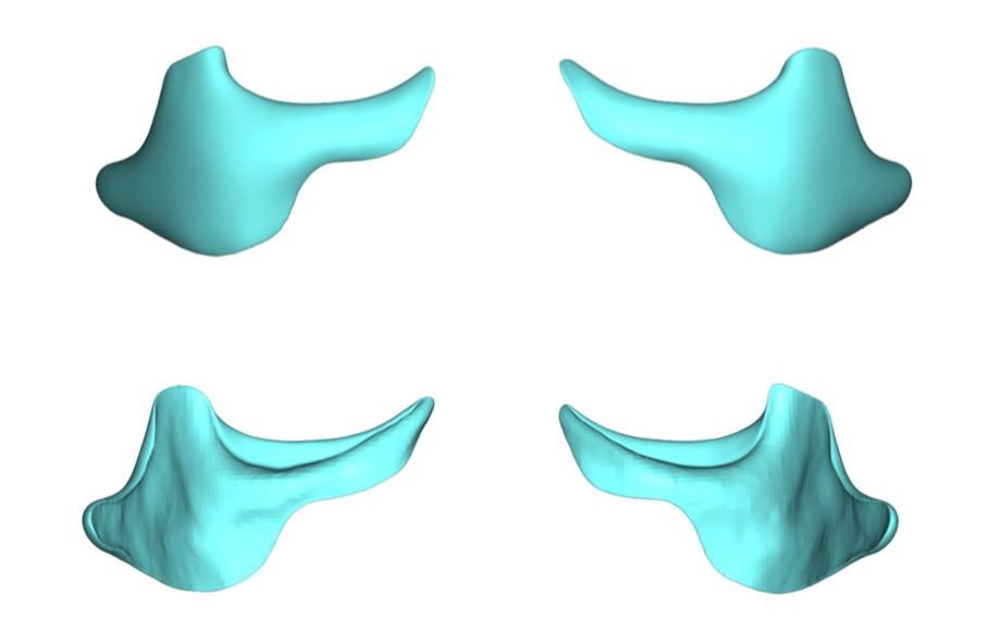 The Concept of the Custom Infraorbital-Malar Implant Design For A ...