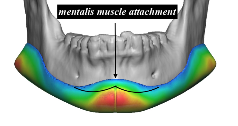 Plastic Surgery Case Study - Treating the Labiomental Fold with Fat ...