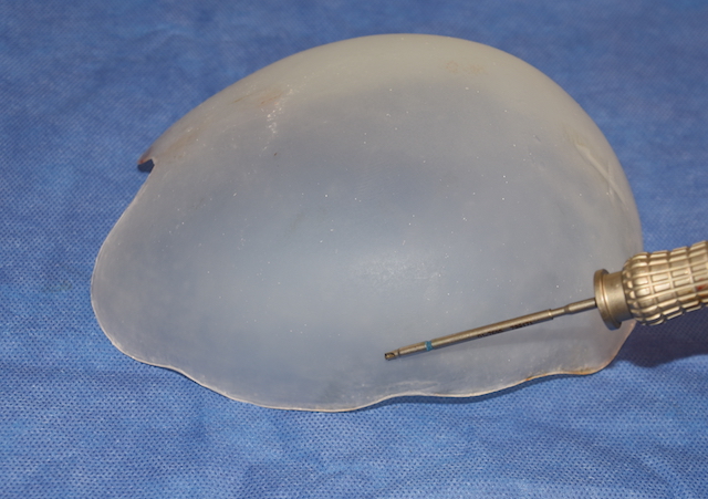 Plastic Surgery Case Study - Custom Skull Implant for the Male Inverted ...