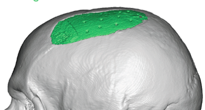 Plastic Surgery Case Study - Custom Skull Strip Implants for Linear ...