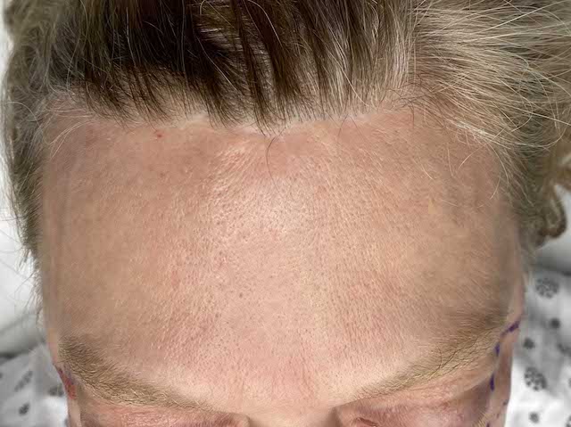 Plastic Surgery Case Study - Long Term Outcome from Female Frontal ...