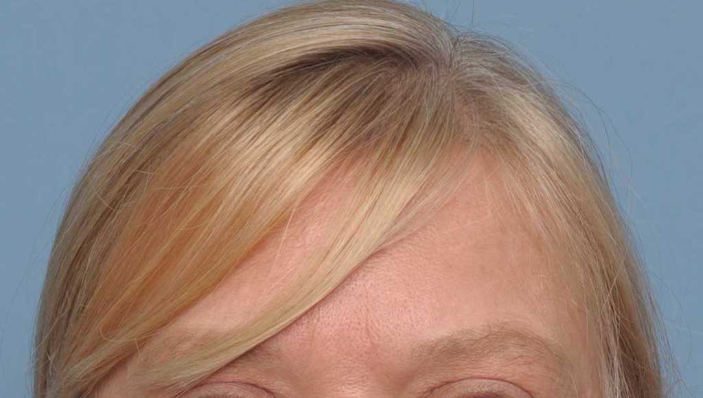 Plastic Surgery Case Study - Long Term Outcome from Female Frontal ...