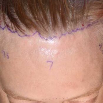 hairline advancement Archives - Explore Plastic Surgery