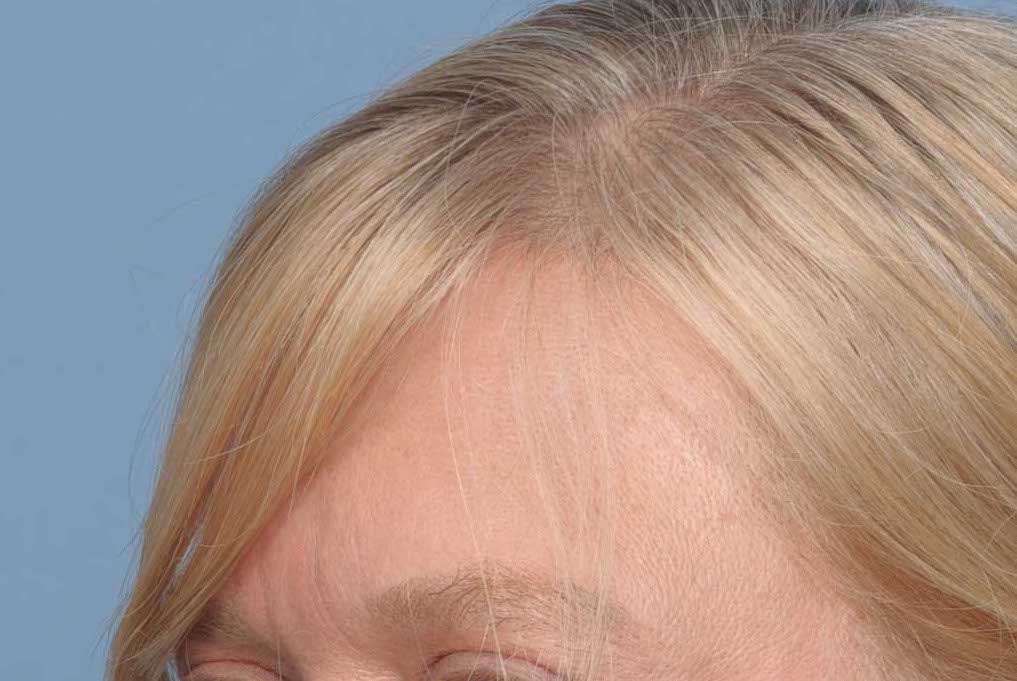 Plastic Surgery Case Study - Long Term Outcome from Female Frontal ...