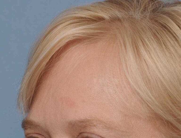 Plastic Surgery Case Study - Long Term Outcome from Female Frontal ...