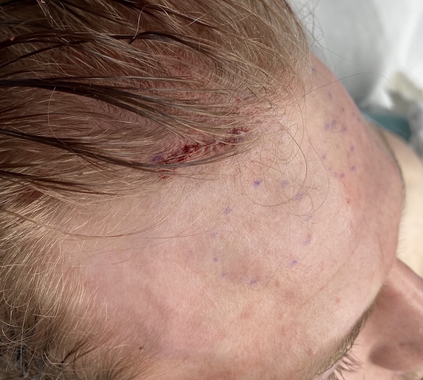 Plastic Surgery Case Study - Forehead Horn Reduction Using Bone ...