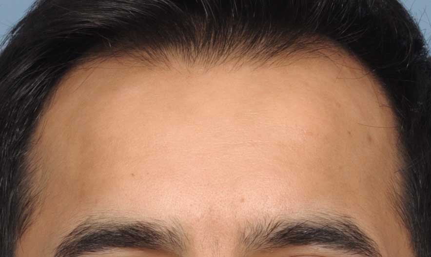 Plastic Surgery Case Study - Male Asymmetric Forehead Horn Reductions ...