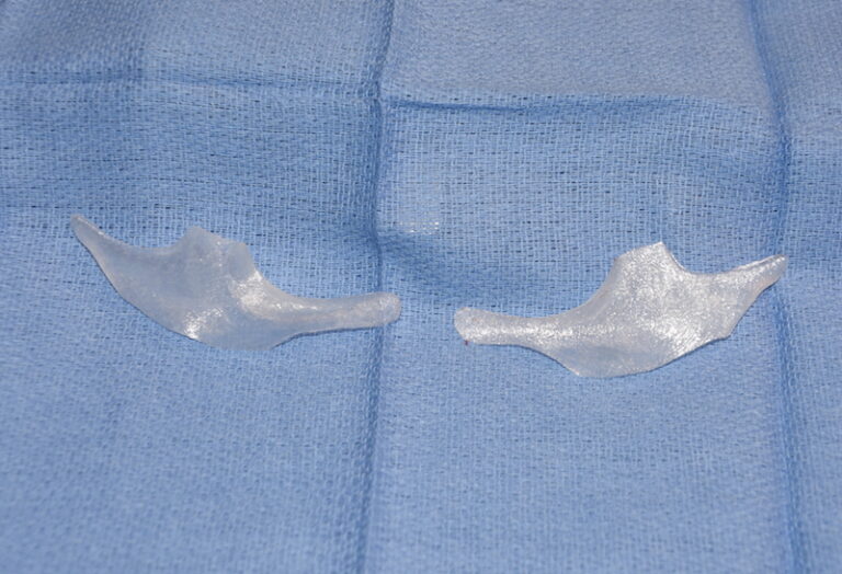 Plastic Surgery Case Study - Total Facial Masculinization with Wrap ...