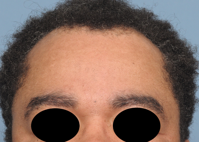 male custom skull implant before Dr Barry Eppley Indianapoplis ...