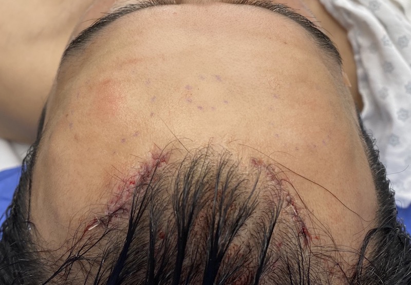 Plastic Surgery Case Study - Male Asymmetric Forehead Horn Reductions ...