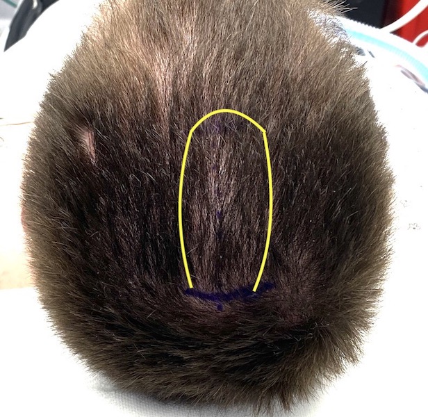 Plastic Surgery Case Study - The Tunnel Technique for the Reduction of ...