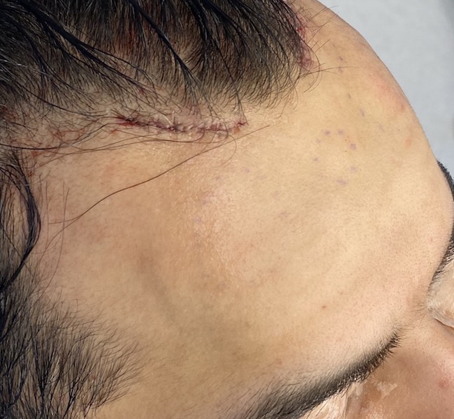 Plastic Surgery Case Study - Male Asymmetric Forehead Horn Reductions ...