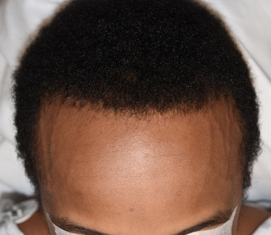 Plastic Surgery Case Study - Male Temporal Reduction Surgery for Wide ...