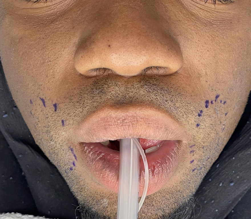 The Role of the Buccinator Mucosal Myectomy in Soft Tissue Cheek ...