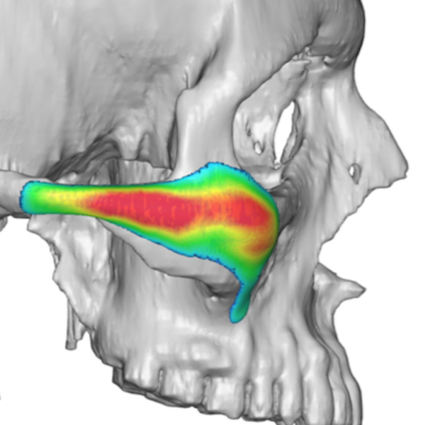 Plastic Surgery Case Study - Replacement of Standard Cheek Implants ...