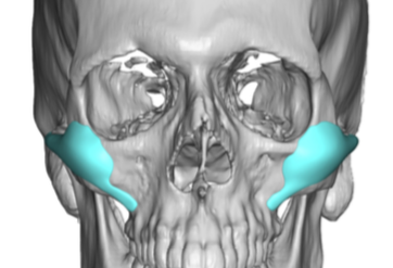 Plastic Surgery Case Study - Replacement of Standard Cheek Implants ...