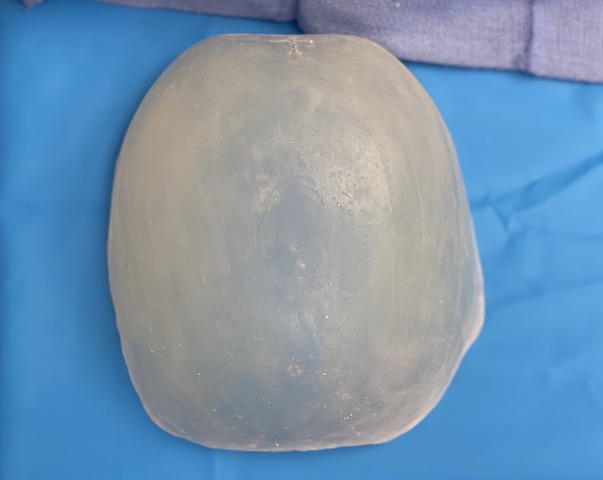 Plastic Surgery Case Study - Adult Scaphocephalic Total Head Reshaping ...