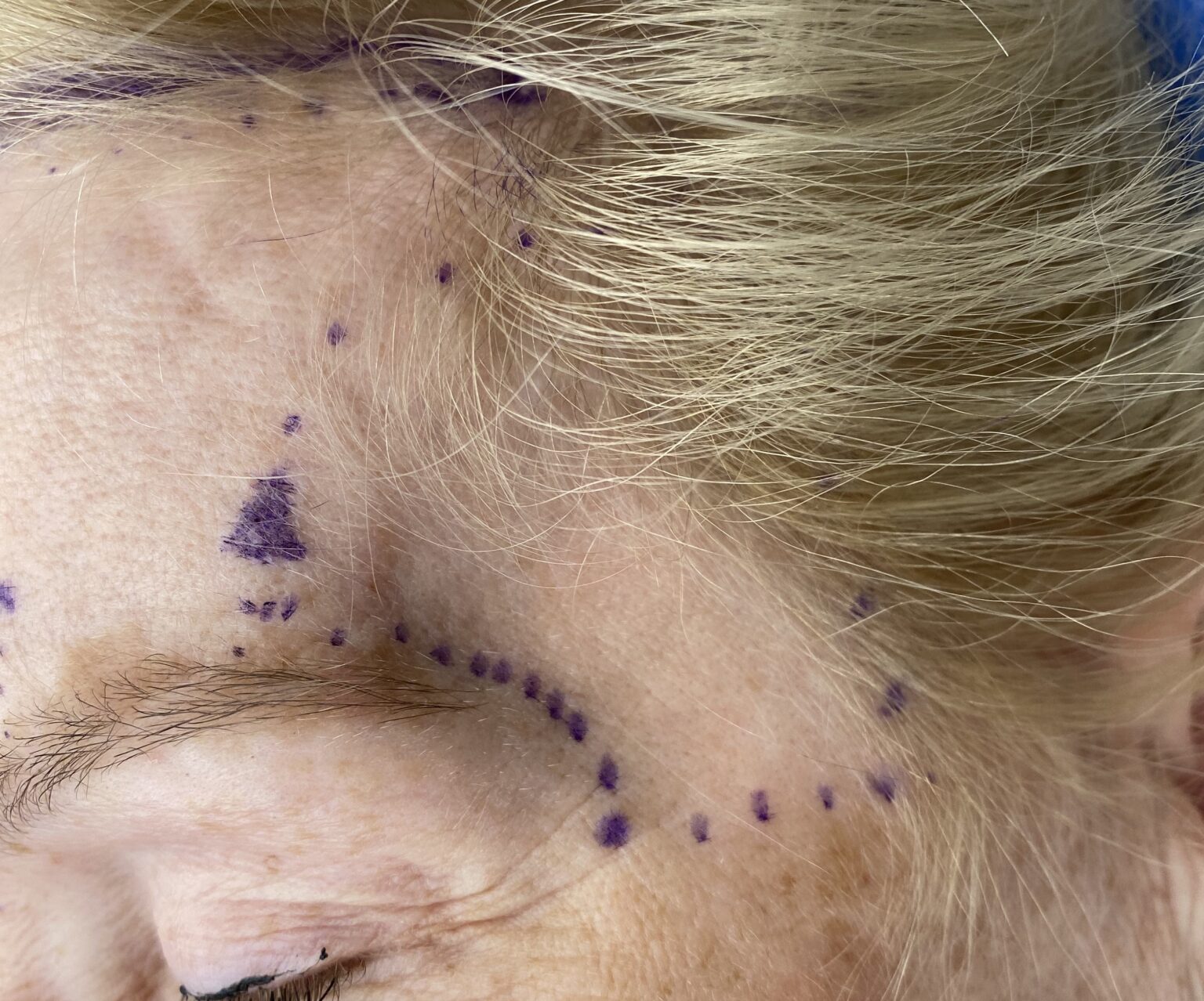 Plastic Surgery Case Study - Placement of Extended Temporal Implants ...