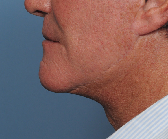 Plastic Surgery Case Study - Scar Outcome From A Direct Jawline ...